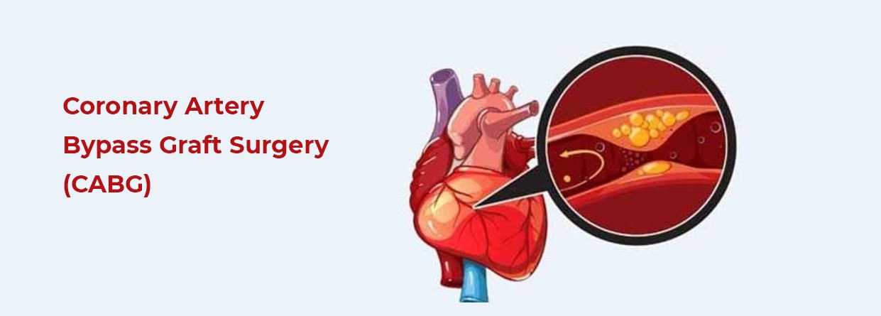 Coronary Bypass Surgery Cartoon Heart Bypass Surgery Stock Vector