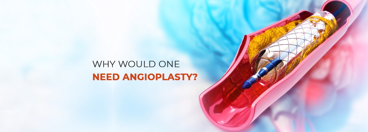 The Role of Angioplasty Explained | BM Birla Hospital