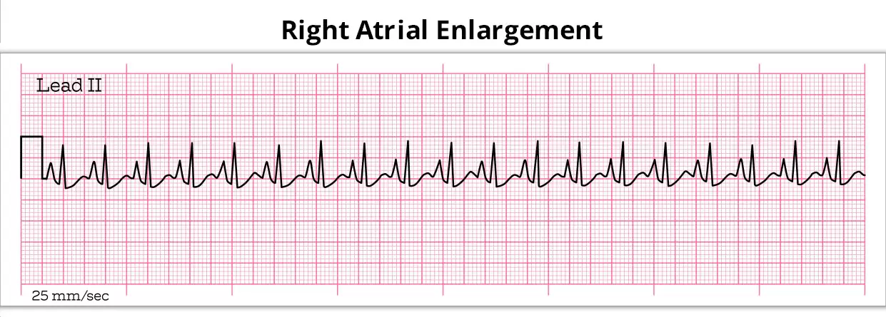 Exploring Right Atrial Enlargement | BM Birla Hospital Kolkata