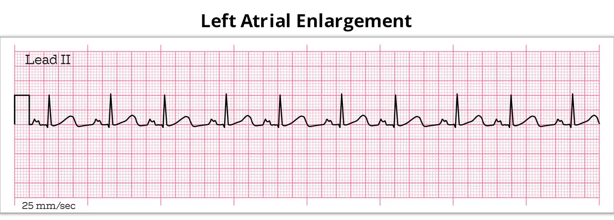 Left Atrial Enlargement Essentials | BM Birla Hospital Kolkata