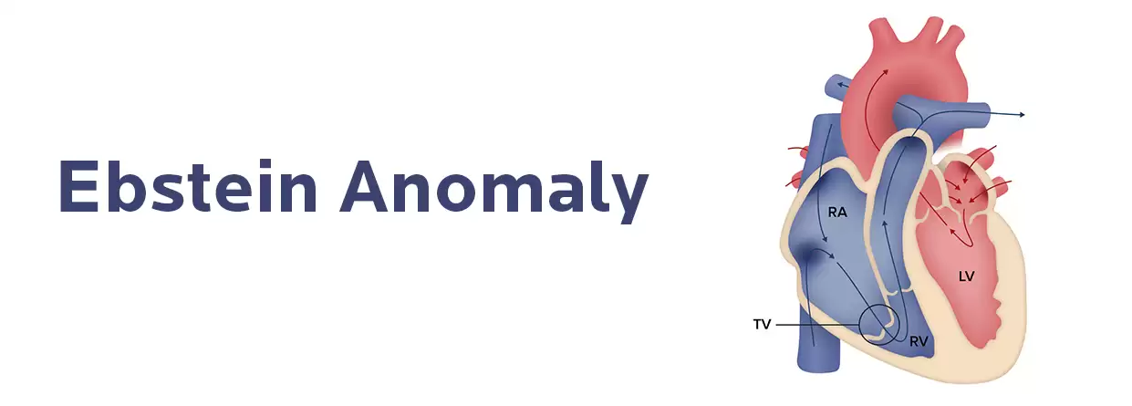 Everything You Need to Know About Ebstein Anomaly - BMB