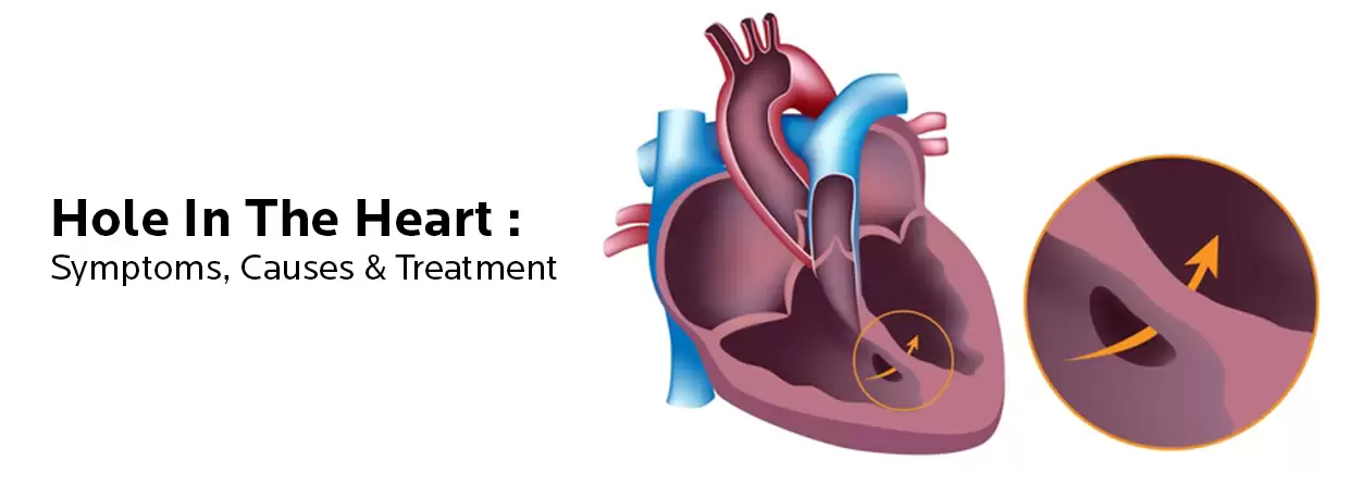 Understanding the Impact of A Hole In The Heart - BMB