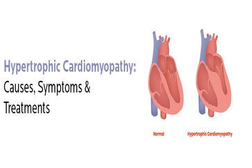 Hypertrophic Cardiomyopathy: Know the Causes, Signs & Treatment