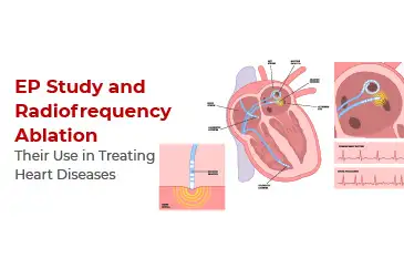 Electrophysiology Studies (EPS) and Radiofrequency Ablation (RFA)