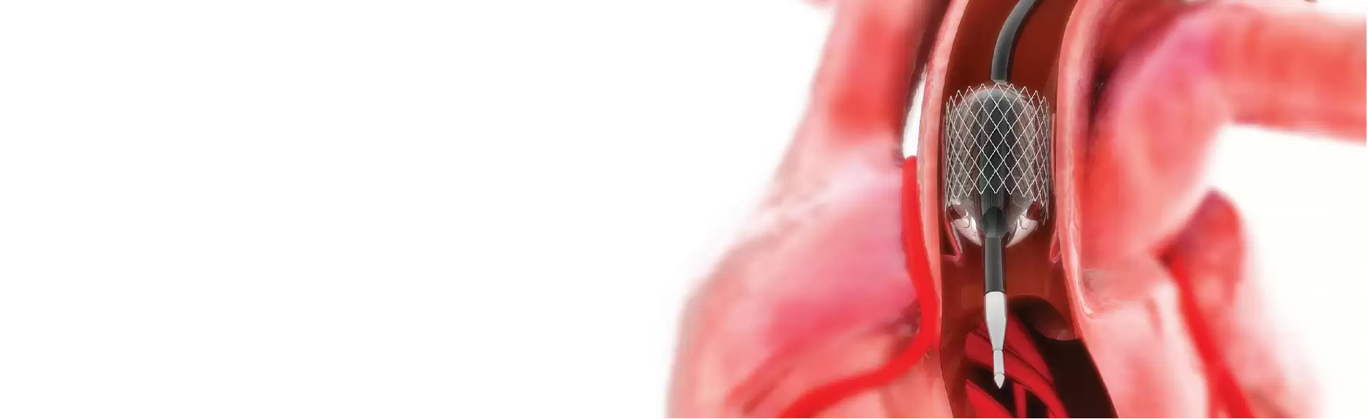 Coronary Angioplasty in Kolkata | BM Birla Heart Hospital