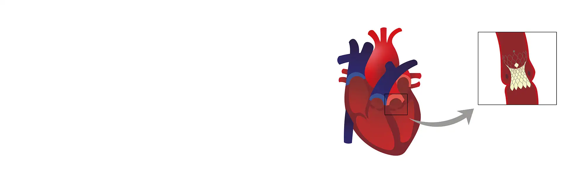 TAVR/TAVI Surgery in Kolkata | Minimally Invasive Heart Valve Treatment