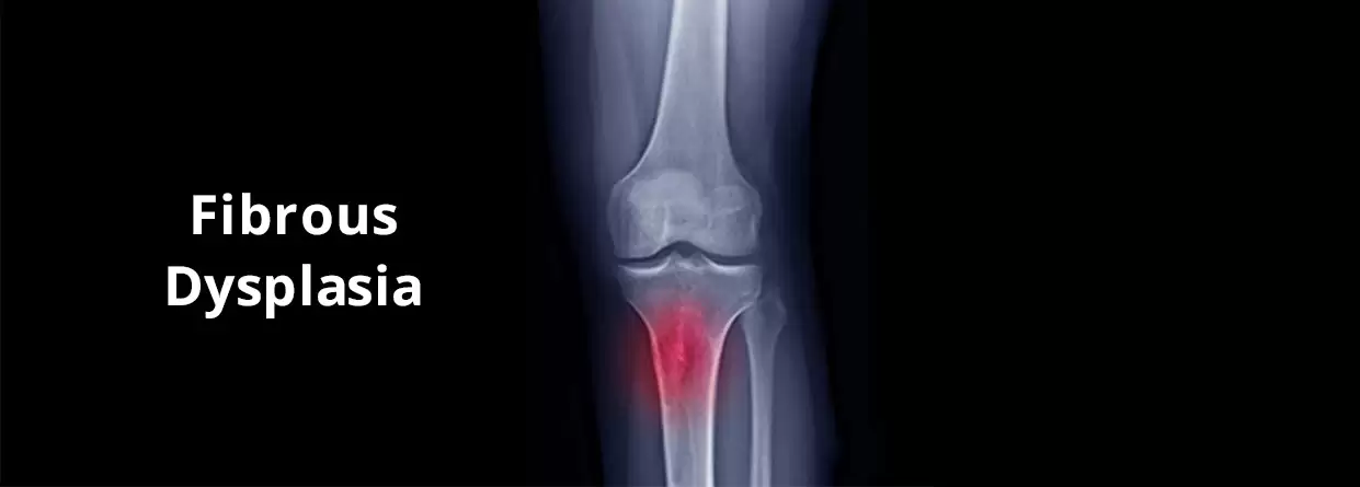 Fibrous Dysplasia - Things You Need To Know