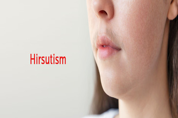 Hirsutism: All You Need to Know - CMRI