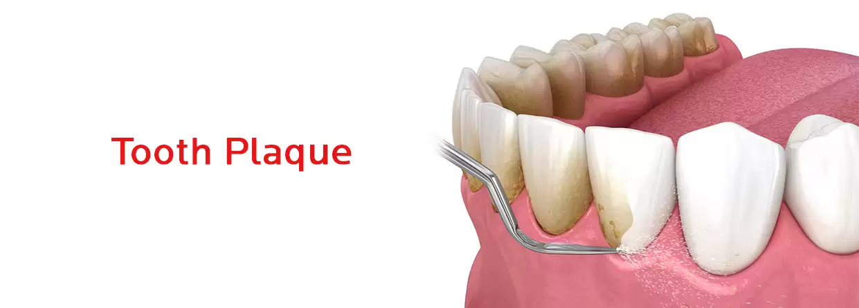 Tooth plaque- Everything You Need to Know - CMRI