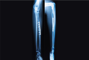 What All You Should Know About Transverse Fracture? - RBH