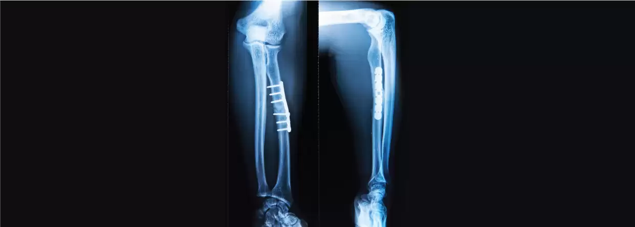 Transverse Fracture Patella Fractures Orthopedic Trauma Service
