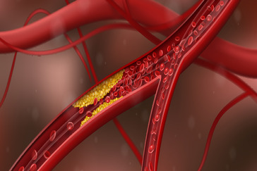 Common Coronary Artery Diseases and their Causes - RBH