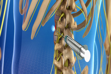 What is a lumbar sympathectomy?