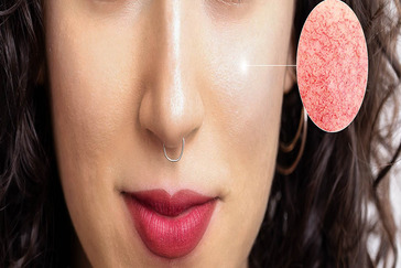 Know The Most Common Diseases Of Dermatology - RBH