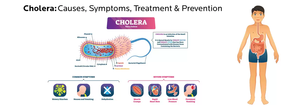 Cholera: Causes, Symptoms, Treatment, and Prevention