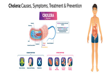 Cholera: Causes, Symptoms, Treatment, and Prevention