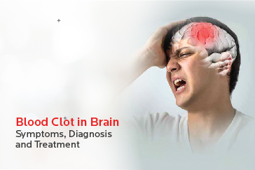 Blood Clot in Brain: Understanding Symptoms, Diagnosis & Treatment - RBH