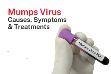 Mumps Virus: Causes, Symptoms & Treatments | CK Birla Hospital