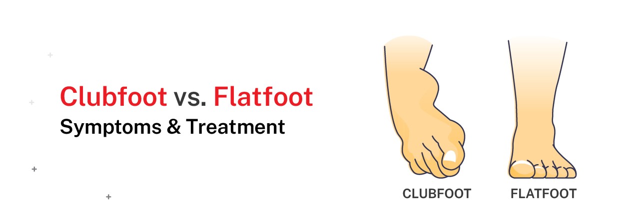 Clubfoot vs. Flatfoot: Key Differences, Symptoms & Treatment