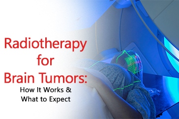 Radiotherapy for Brain Tumors: Procedure, Benefits & What to Expect