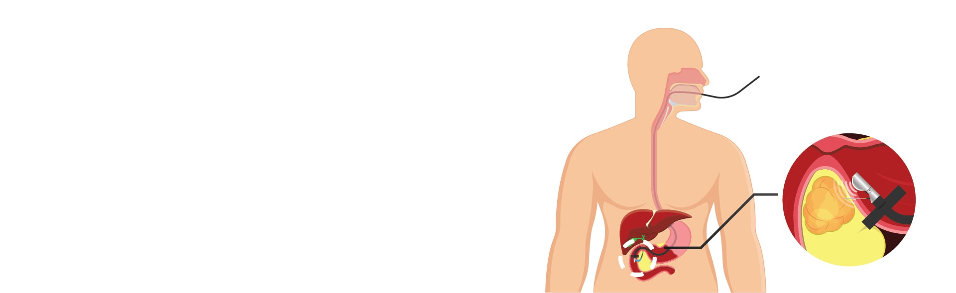 Endoscopic Ultrasound (EUS) in Jaipur | Accurate Diagnosis & Safe Procedure